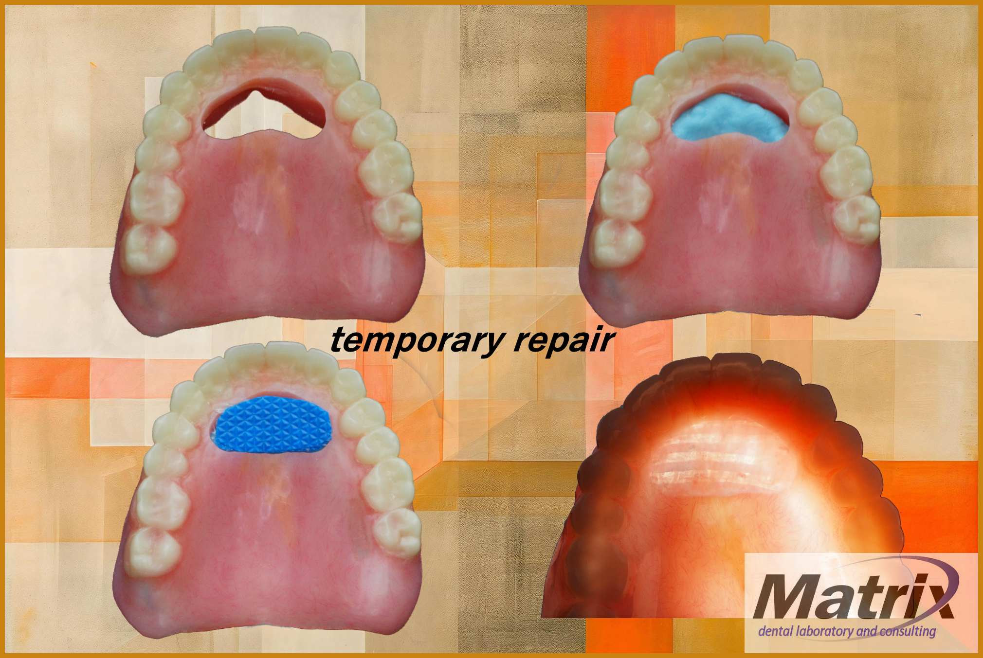 Temporary Repair? – Matrix Dental Laboratory and Consulting