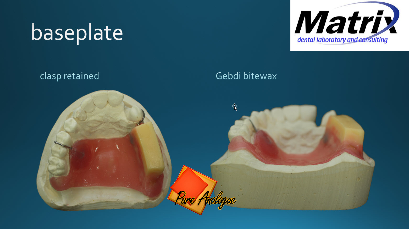 Stabilized Baseplates – Matrix Dental Laboratory and Consulting