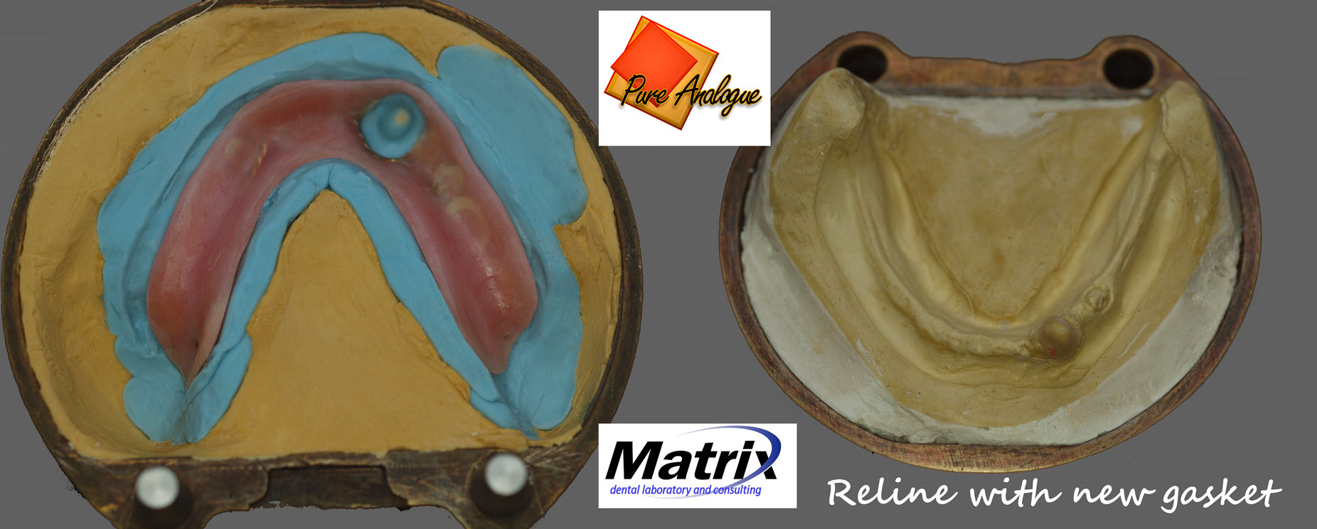 Old School…For the win! – Matrix Dental Laboratory and Consulting